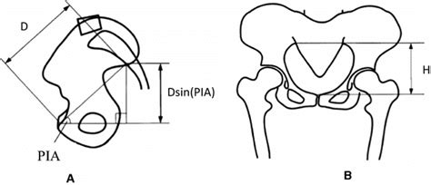 The Method For Calculating The Pelvic Inclination Angle Pia 15 A Download Scientific
