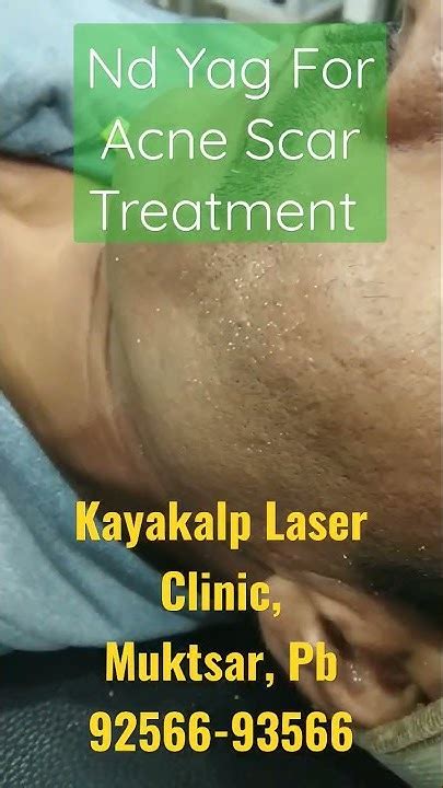 Nd Yag Laser For Acne Scar Treatment Youtube