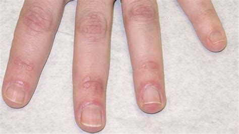 Finding This On Your Nails May Be A Sign Of Diabetes Womans World