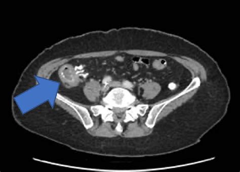Tomografía Axial Computarizada Contrastada Corte Coronal Apéndice