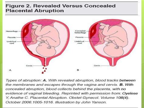 Placental Abruption Online Presentation
