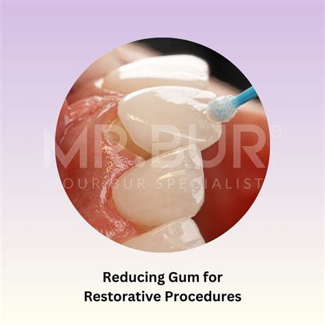 4 Key Situations Where Gingivectomy Is Essential For Optimal Oral Health Mr Bur