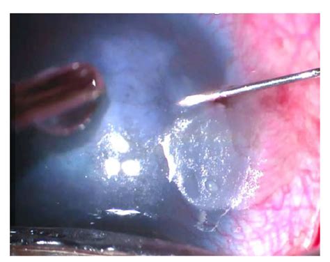 Mitomycin Intravascular Chemoembolization A Treatment For Corneal