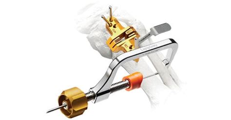 Treace Medical Concepts Secures Financing Orthoworld