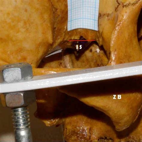 Relationship With Infratemporal Crest A A Complete Relation Between Download Scientific