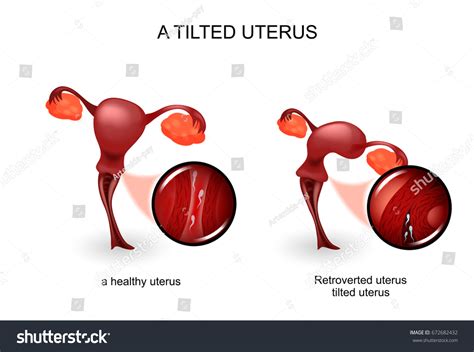 Tilted Cervix