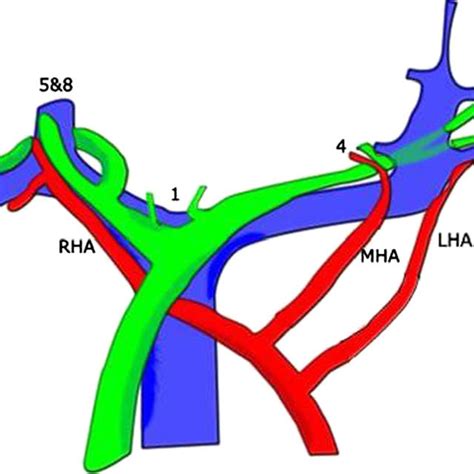 Limit Of Resection Of Bile Ducts With A Right Hepatectomy And B Download Scientific Diagram