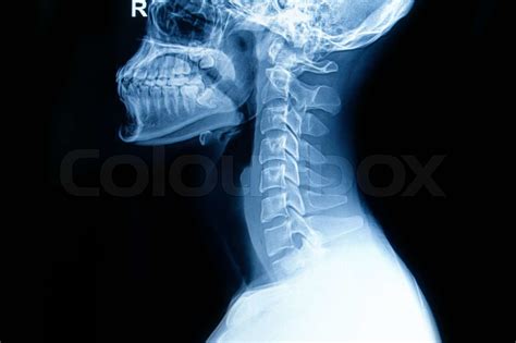 X Ray Of Human Cervical Spine Stock Image Colourbox