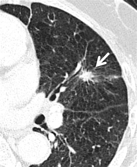 What Do Lung Nodules Look Like On Ct Scan Ct Scan Machine