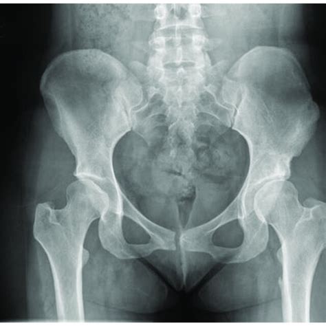 Ap Pelvis In Patient 20 Years Following Open Reduction And Pelvic