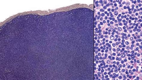 Small Lymphocytic Lymphoma Showing Diffuse Effacement By Small Lymphoid Download Scientific