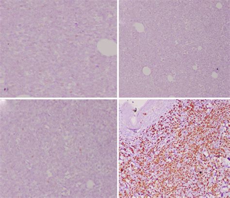 Neoplastic Cells Were Negative For Cd23 A B Cell Lymphoma 6 B And