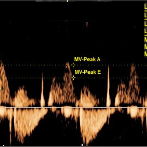 normal mpi and e a ratio doppler tracing mpi myocardial performance