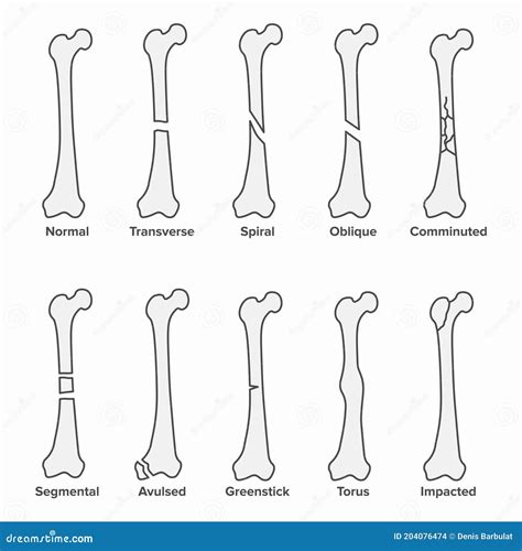 Types Of Fractures Broken Bones Vector Illustration 204076474