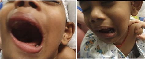 Concurrent Facial Nerve Palsy And Uvula Deviation After Paediatric
