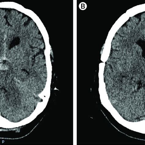 Head Computed Tomography Ct Scan A Subarachnoid Hemorrhage Is