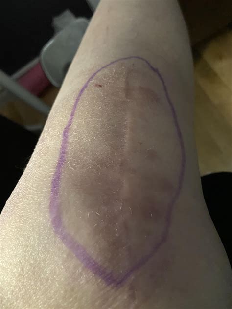 14 Weeks Post Mcl Surgical Repair Rpopping