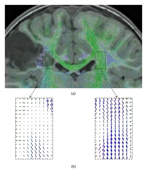 In Vivo Dataset With Tumorous Tissue Infiltrating The Right Branch Of