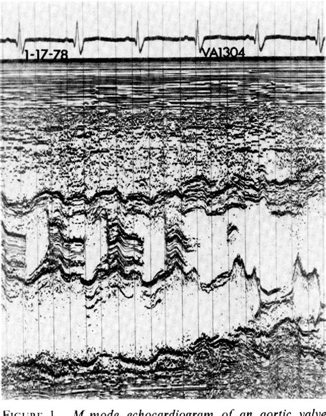 Figure 1 From Comparison Of M Mode And Cross Sectional Echocardiography
