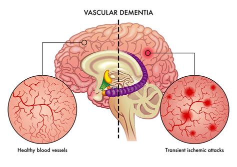Vascular Dementia Stock Illustrations 201 Vascular Dementia Stock