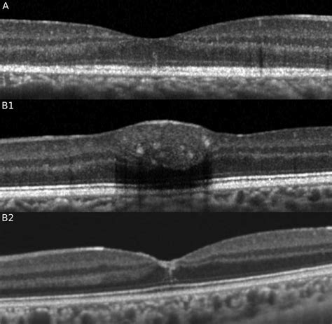 Sd Oct Showing The Presence Of The Characteristic Hyper Reflective Line