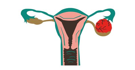 Ovarian Cyst Surgery Things To Consider Before And After