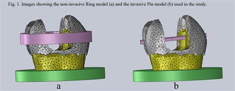 Finite Element Analysis Comparison Between Invasive And Non Invasive Artificial Marginal Ridges