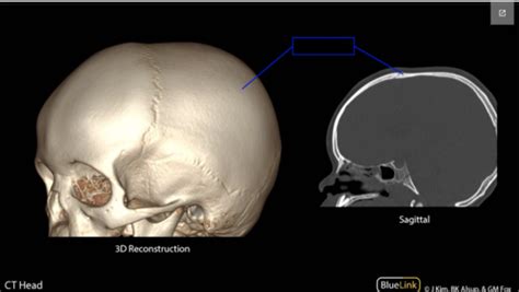 Ct Scans Of Skull Flashcards Quizlet