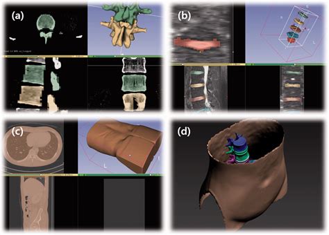 Segmentation Of The Vertebrae And Pelvic Bone Intervertebral Discs