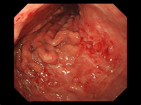 Endoscopic Findings Of Gastric Syphilis Showing Diffuse Erythema