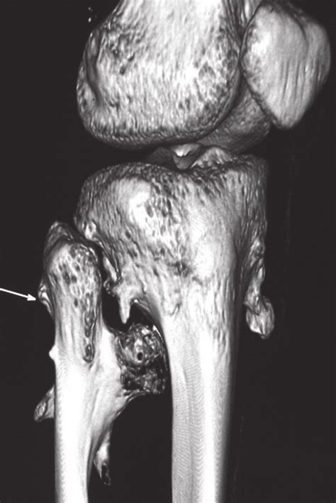 Ct Scan Showing The Osteophyte Over The Fibula Neck White Arrow Download Scientific Diagram
