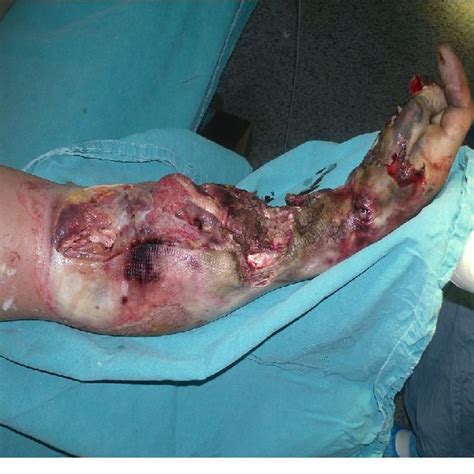 A 22 Year Old Male With High Voltage Electrocution Of The Upper Right Download Scientific