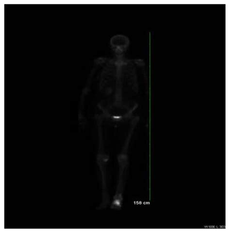 Technetium 99m Mdp Whole Body Bone Scan Displaying Intense Increased Download Scientific