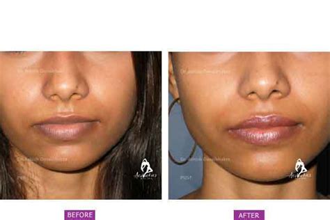 Get Perfect Lips With Lip Surgery Advanced Aesthetics Pune