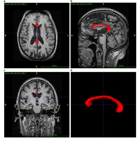 figure 5 from semi automatic corpus callosum segmentation and 3d