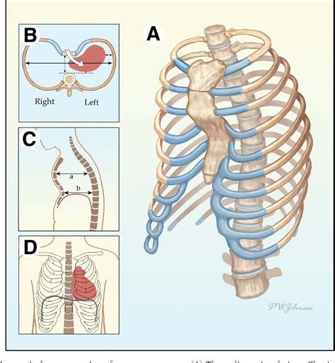 Types Of Rib Cage Deformities Design Talk