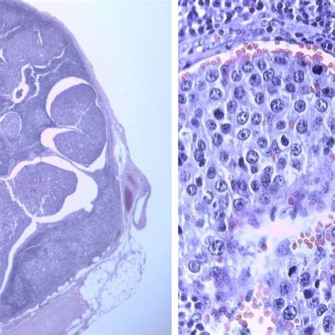Surgical Piece Left Axillary Node Download Scientific Diagram