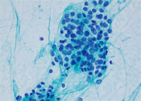 Pathology Outlines Ewing Sarcoma