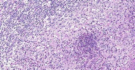 Tuberculosis Histology