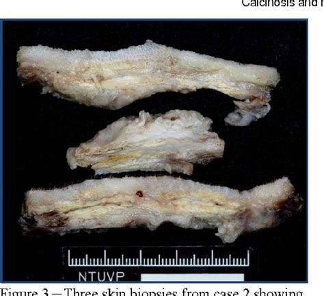 Figure 3 From Calcinosis Cutis Calcinosis Circumscripta And “ Mille