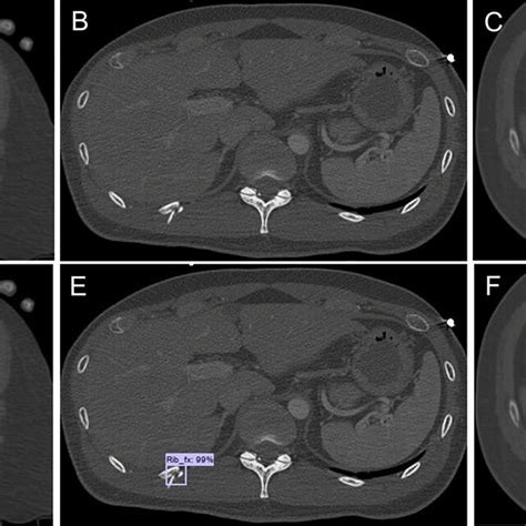 Sample Ct Images Correctly Annotated By Neural Networks On The Testing