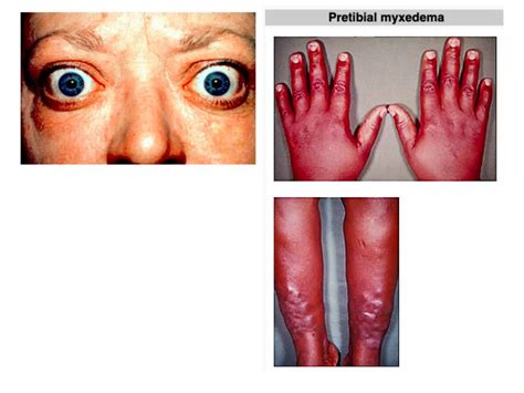 Thyroid Function Test Tft In Simple Way Pdf Thyroid Function Test Tft In Simple Way Pdf