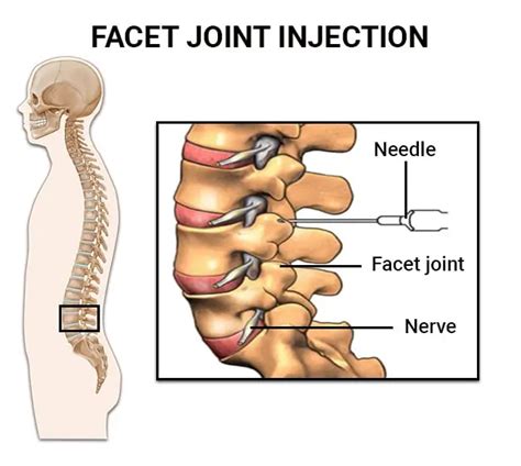Facet Joint Injections In Chicago Il Painless Medical Practice