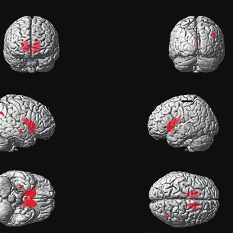 Voxel Based Morphometric Analysis Showing The Atrophic Regions In