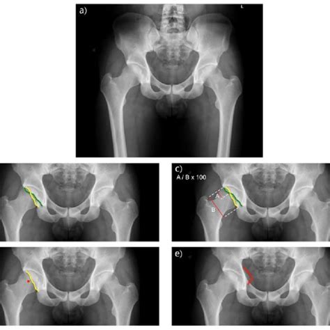 Pdf Acetabular Retroversion Diagnosis And Treatment