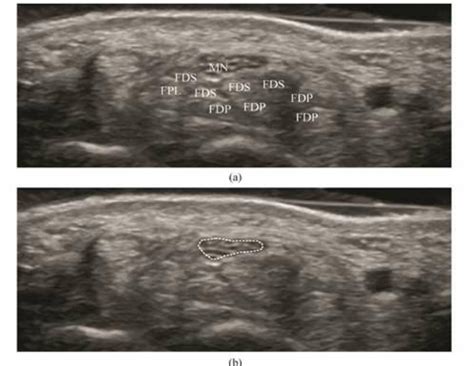 A Appearance Of Tendons And Median Nerve At Proximal Carpal Tunnel Download Scientific