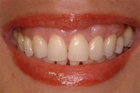 pin on root coverage with tunneling technique in a gummy smile case by