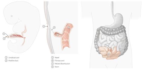 Meckels Diverticulum Scan Frontiers Meckels Diverticulum Analysis