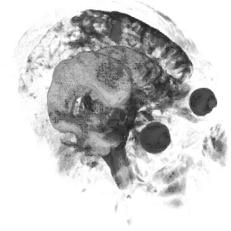 Imagej Application Displaying Frontal View Of Mri Angiogram Of The