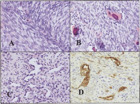 Biphasic Synovial Sarcoma A The Spindle Cell Component Showing Download Scientific Diagram